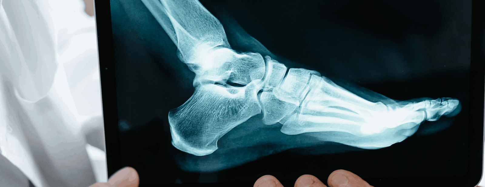 Why You Need Calcium Supplements: The Top 10 Health Benefits